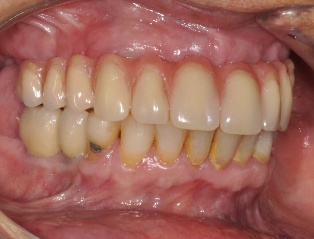 Prótesis dentales | Clínica dental | Matias San Martin